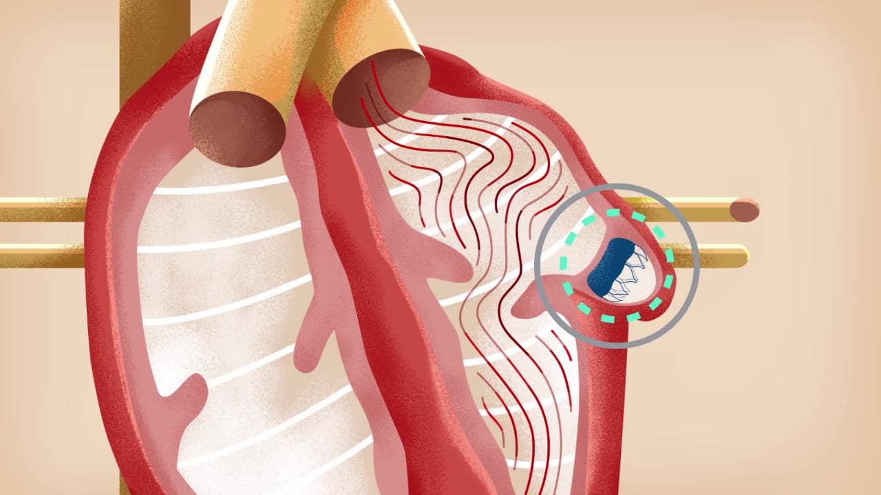 WATCHMAN Left Atrial Appendage Closure Device on Vimeo