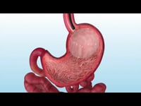 Intragastric Balloon Placement