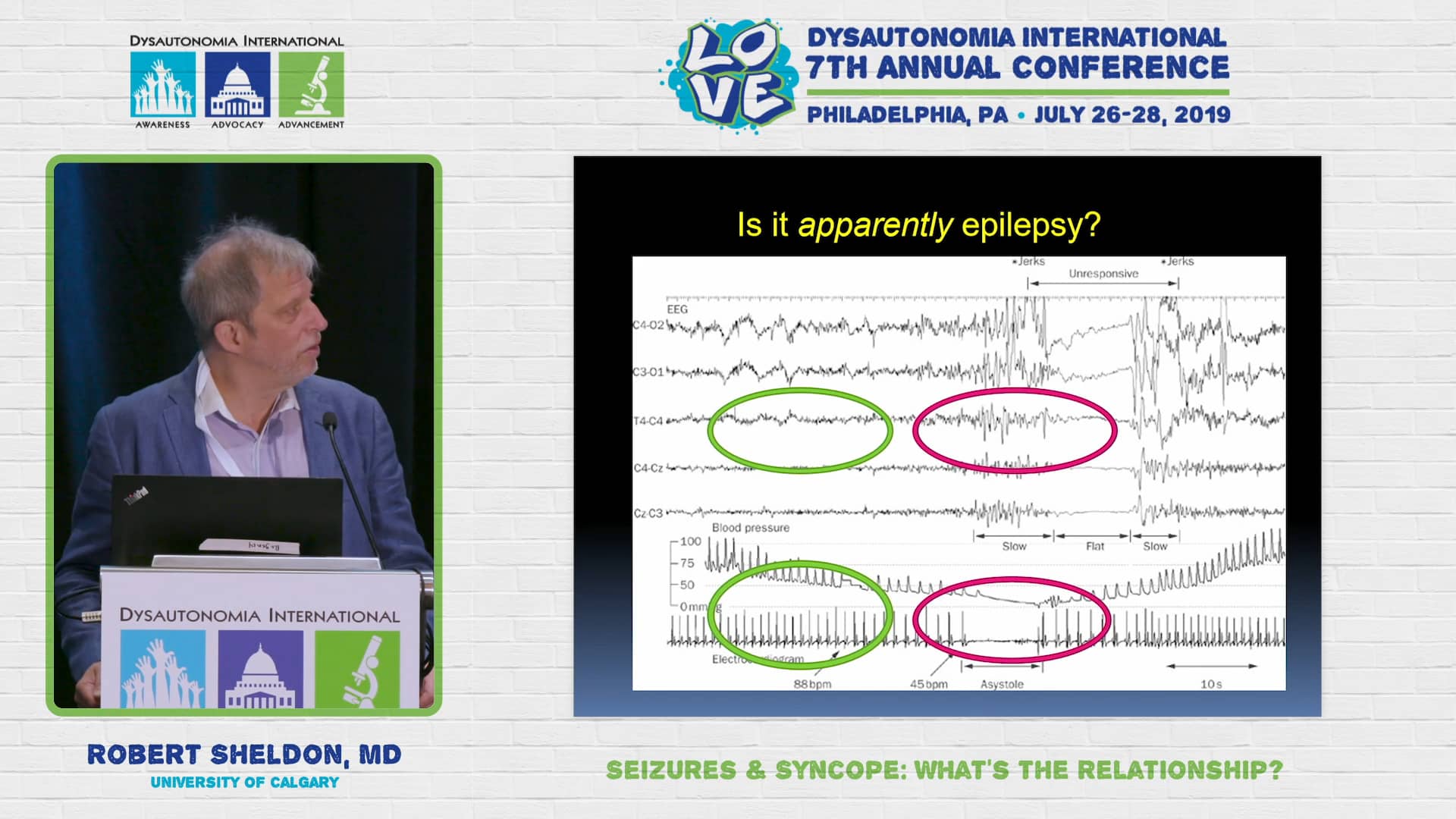 Seizures & Syncope: What’s the Relationship? - Robert Sheldon, MD, PhD ...