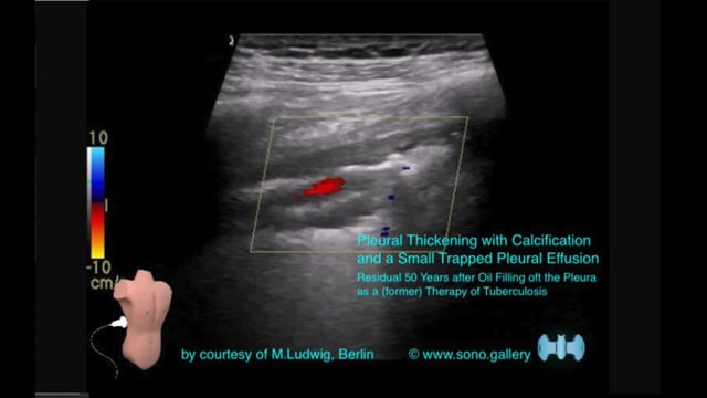 Subphrenic Abscess - SONO.GALLERY