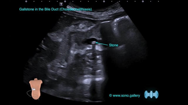 Air in Bile Tract (Pneumobilia) - SONO.GALLERY