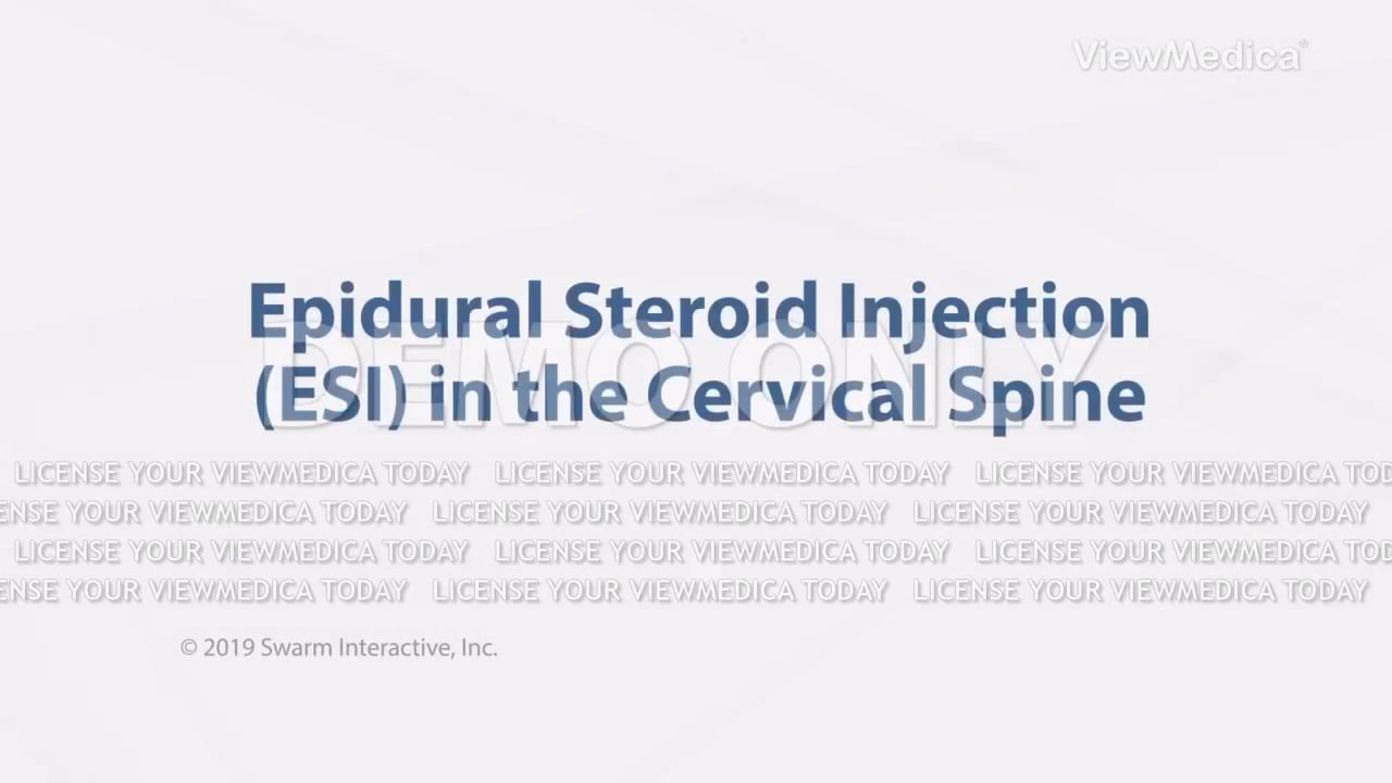 Cervical Epidural Steriod Injection on Vimeo