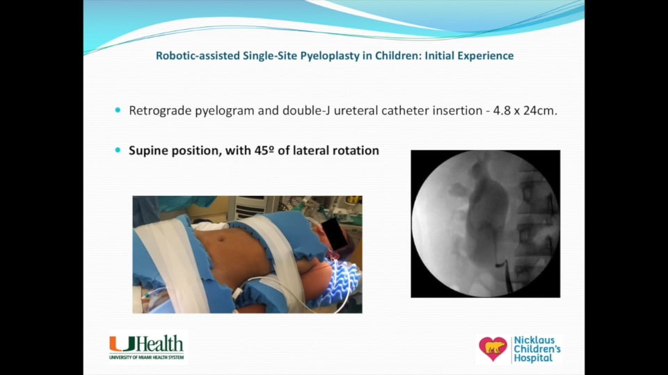 271- Robotic-assisted single site pyeloplasty in children-initial ...