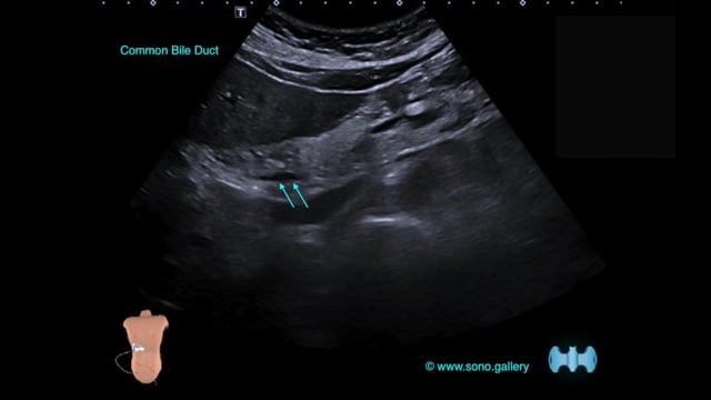 Urinary Bladder, Artifact - SONO.GALLERY