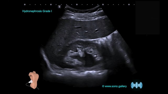 Air in Bile Tract (Pneumobilia) - SONO.GALLERY