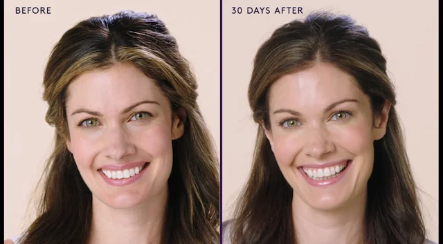 Botox Before And After Eyes Unique Design | www.pinnaxis.com Botox Before And After Eyes Unique Design | www.pinnaxis.com