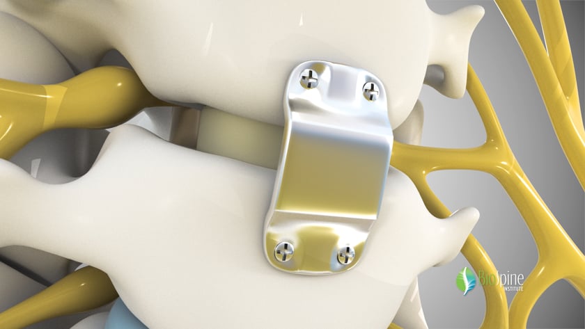 Anterior Cervical Discectomy With Fusion (ACDF) | BioSpine Institute