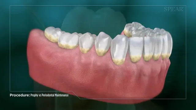 Prophy vs Periodontal Maintenance on Vimeo