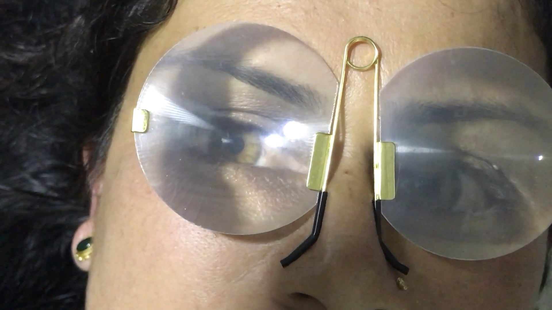 Left ear cold water caloric, nystagmus to right (opposite) side, seen ...