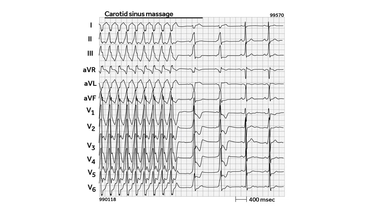 Monday Lecture - ECG 25_4 on Vimeo