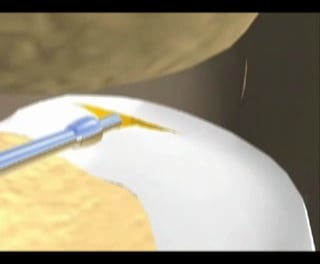 meniscal_dart-puncture on Vimeo