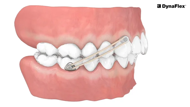 Invisalign Button Rubber Bands