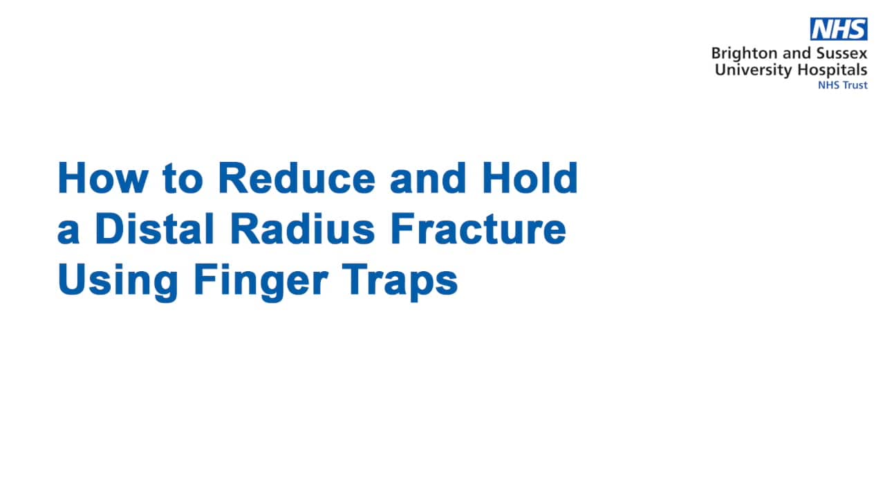 How to Reduce and Hold a Distal Radius Fracture Using Finger Traps on Vimeo