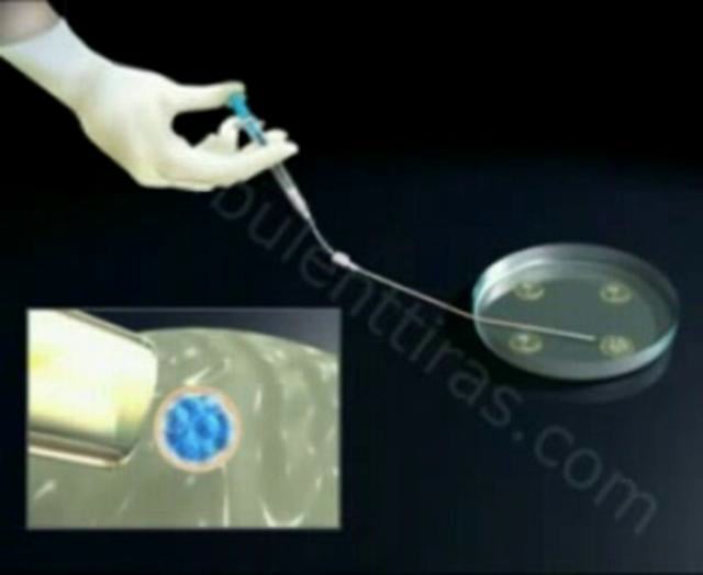 Dondurulmuş Embriyo Transferi (frozen embryo transfer) on Vimeo