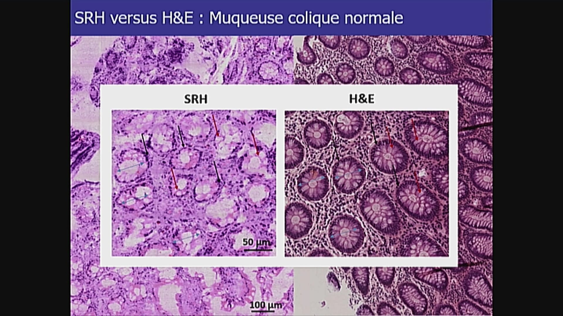 2020 - Anapath instantanée en per-opératoire : la technologie SRH. Dr ...