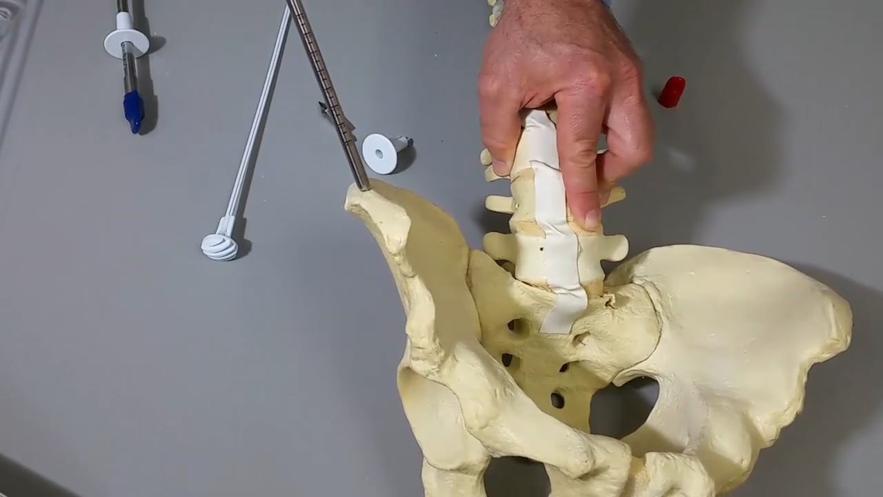 COREX™ | Anterior Iliac Crest Bone Graft (Ant ICBG) on Vimeo