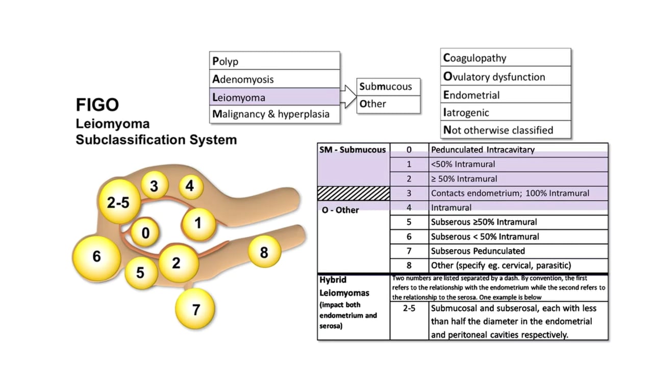 FIGO_Leiomyoma_subclassification on Vimeo