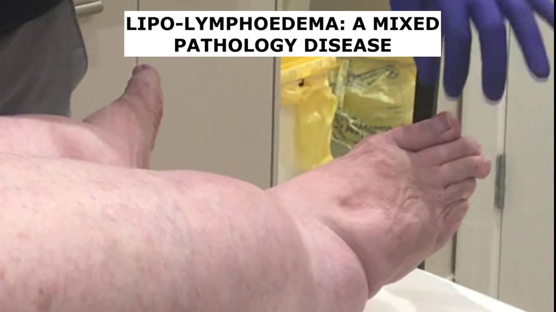 LIPO-LYMPHOEDEMA A MIXED PATHOLOGY DISEASE_2019_11_23_22_09_57 on Vimeo