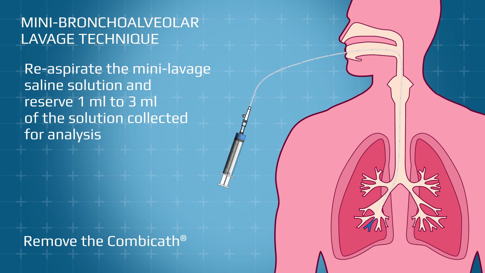 Combicath per MINI BAL on Vimeo