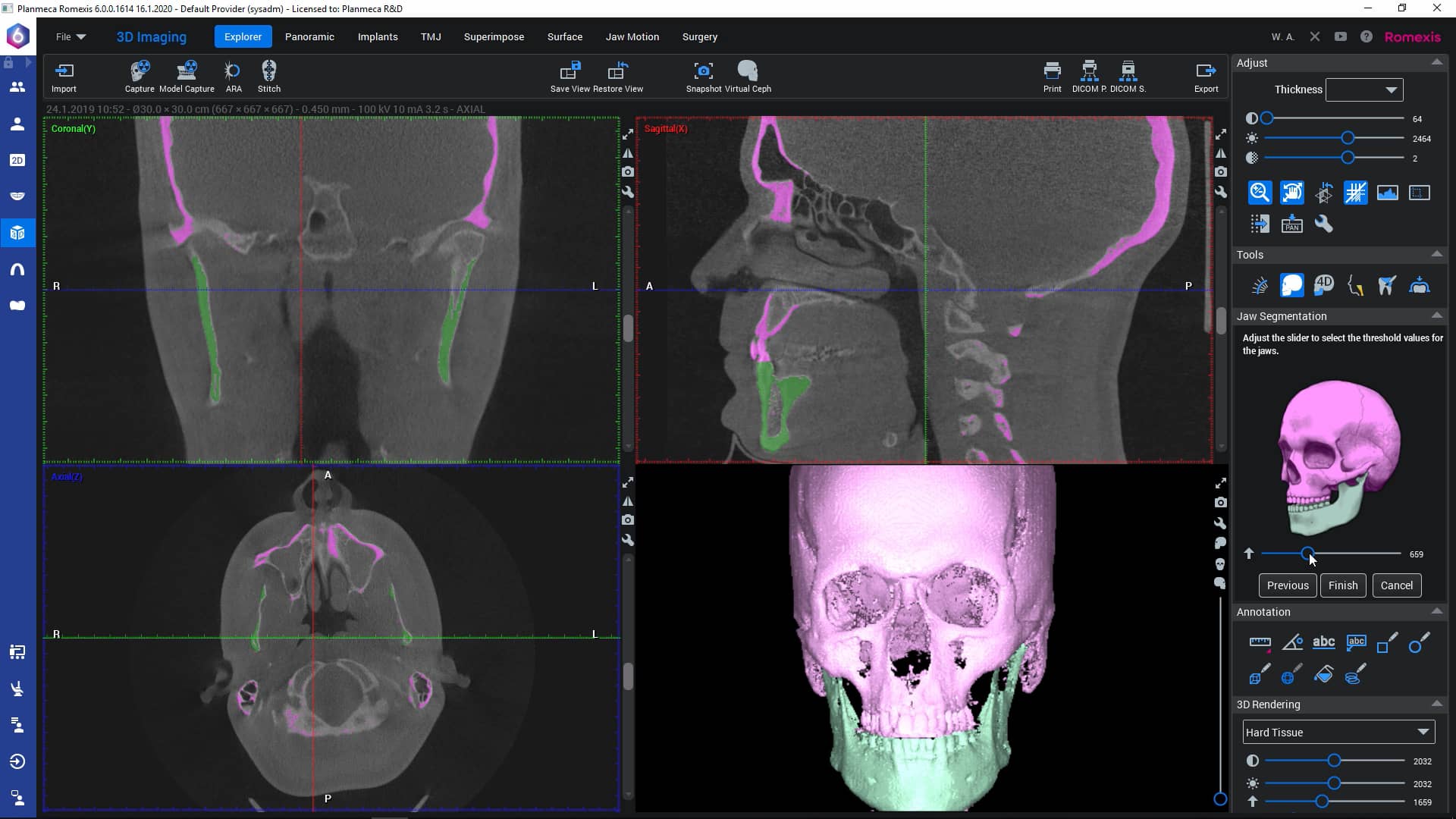 How to - Segment upper and lower jaws from CBCT in Planmeca Romexis on ...
