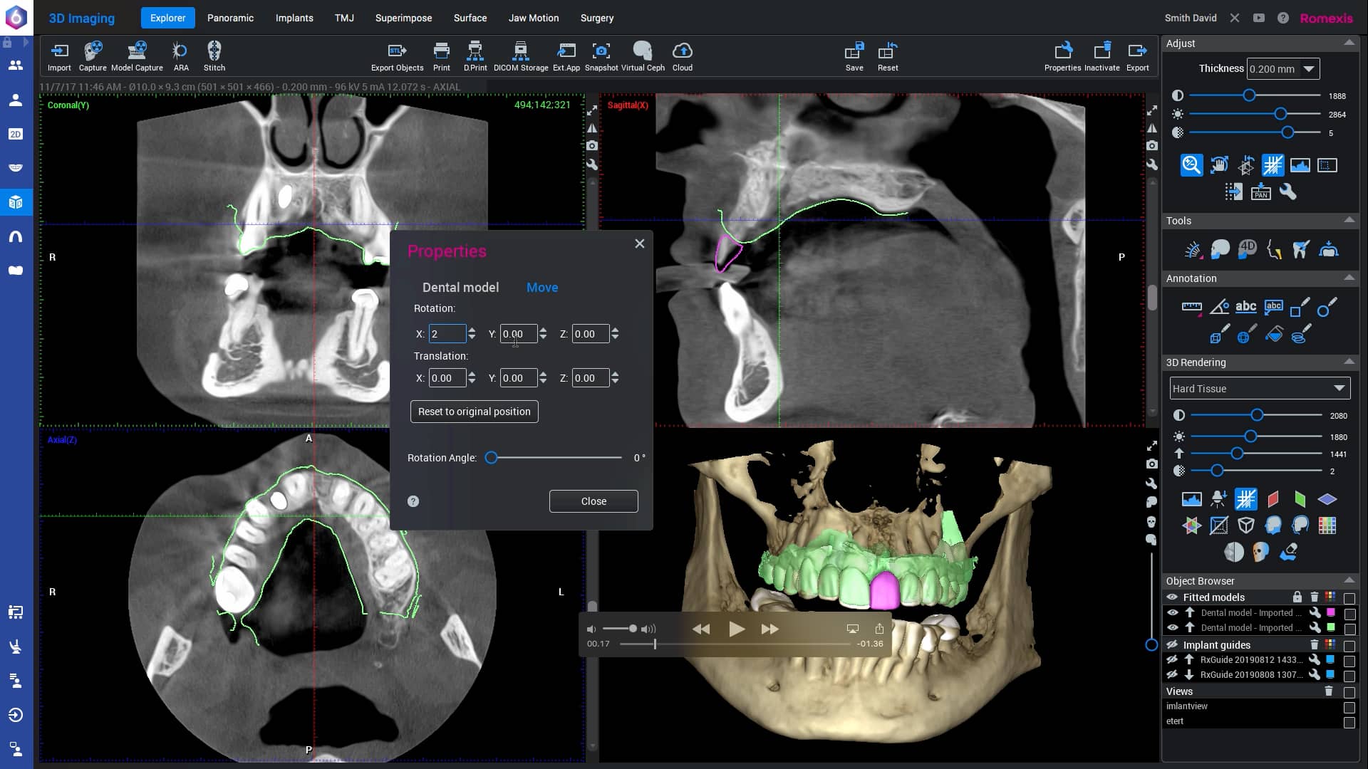 How to- Move STL scan manually in CBCT image in Planmeca Romexis on Vimeo