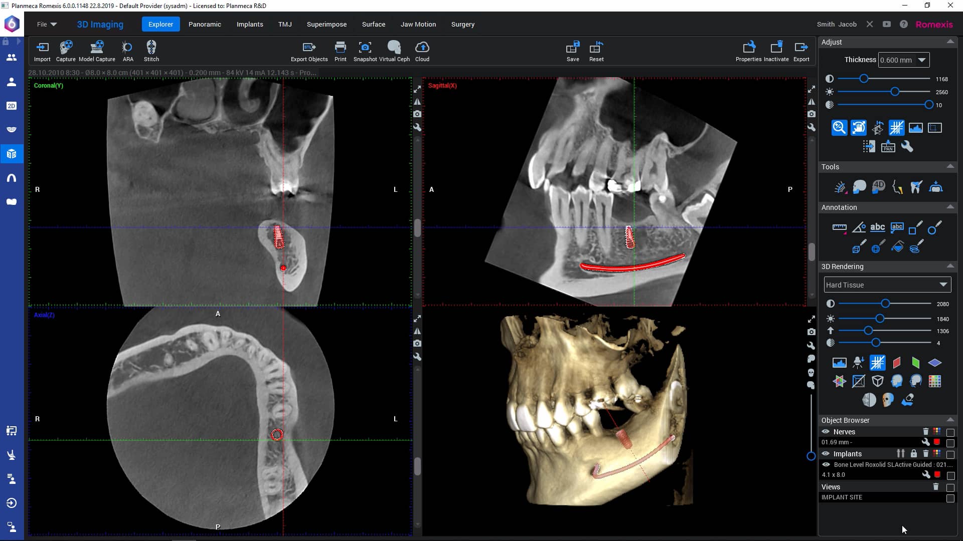 How to - Import a CBCT image in DICOM multiframe format to Planmeca Romexis on Vimeo