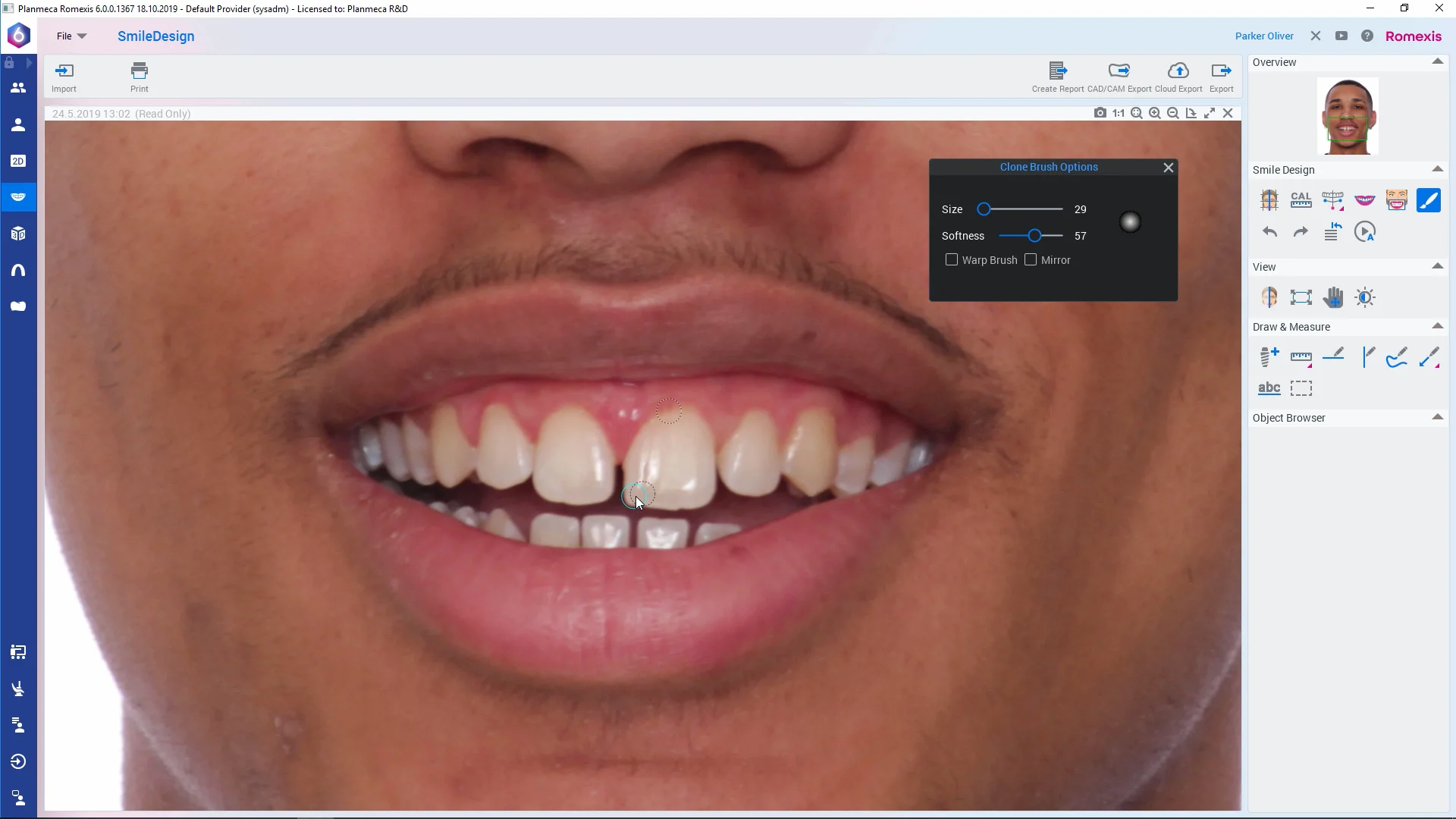How to - Use clone tool in Smile Design in Planmeca Romexis on Vimeo