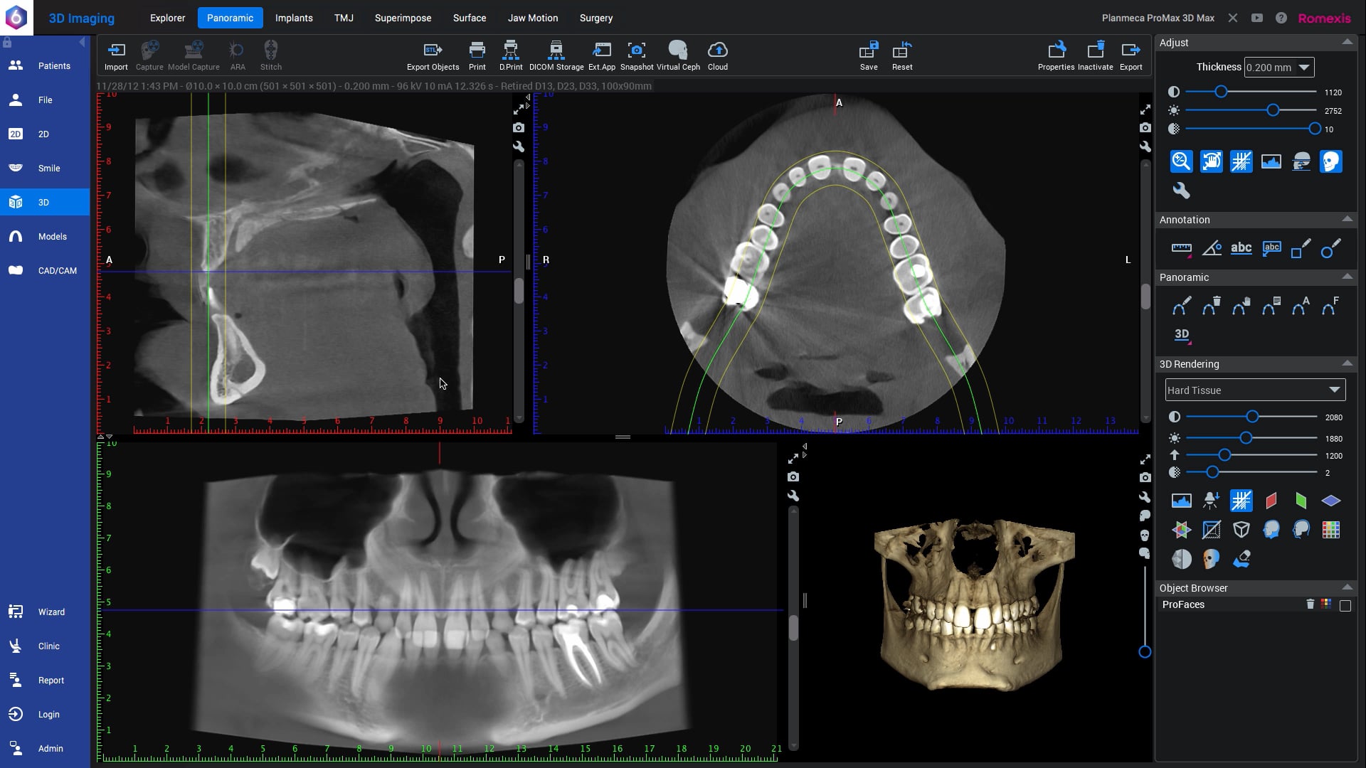 How to - Create panoramic view from CBCT in Planmeca Romexis on Vimeo