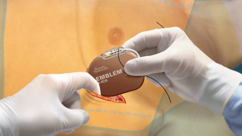 S-ICD-Implant Procedure on Vimeo