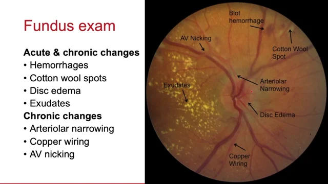 Hypertensive Retinopathy Macular Star