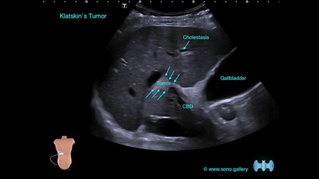 Klatskin´s Tumor - SONO.GALLERY