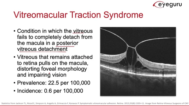 Vitreous Traction Syndrome