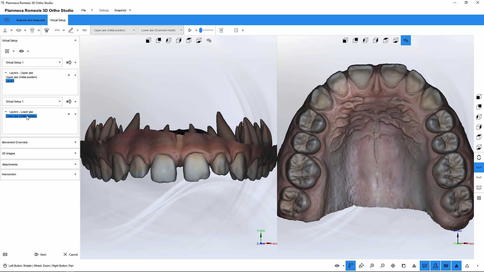 How to - Simulate tooth movement in Ortho Studio in Planmeca Romexis on ...