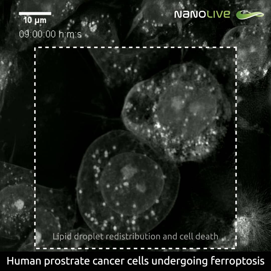 Nanolive technology reveals ferroptosis execution in an aggressive ...