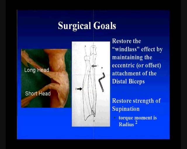 Distal Biceps Repair using EndoButton on Vimeo