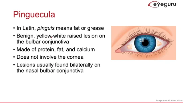 Pinguecula