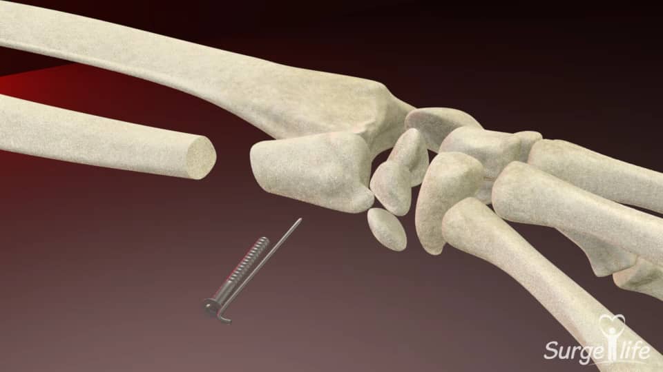 INTERVENTION de SAUVE KAPANDJI POIGNET Dr Renaud DUCHÉ Avignon on Vimeo