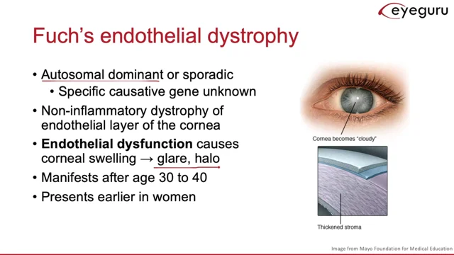 Fuchs Endothelial Dystrophy