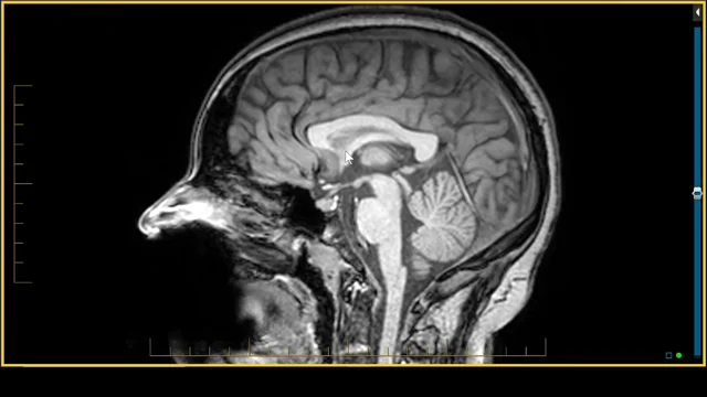 Mri Paracentral Lobule