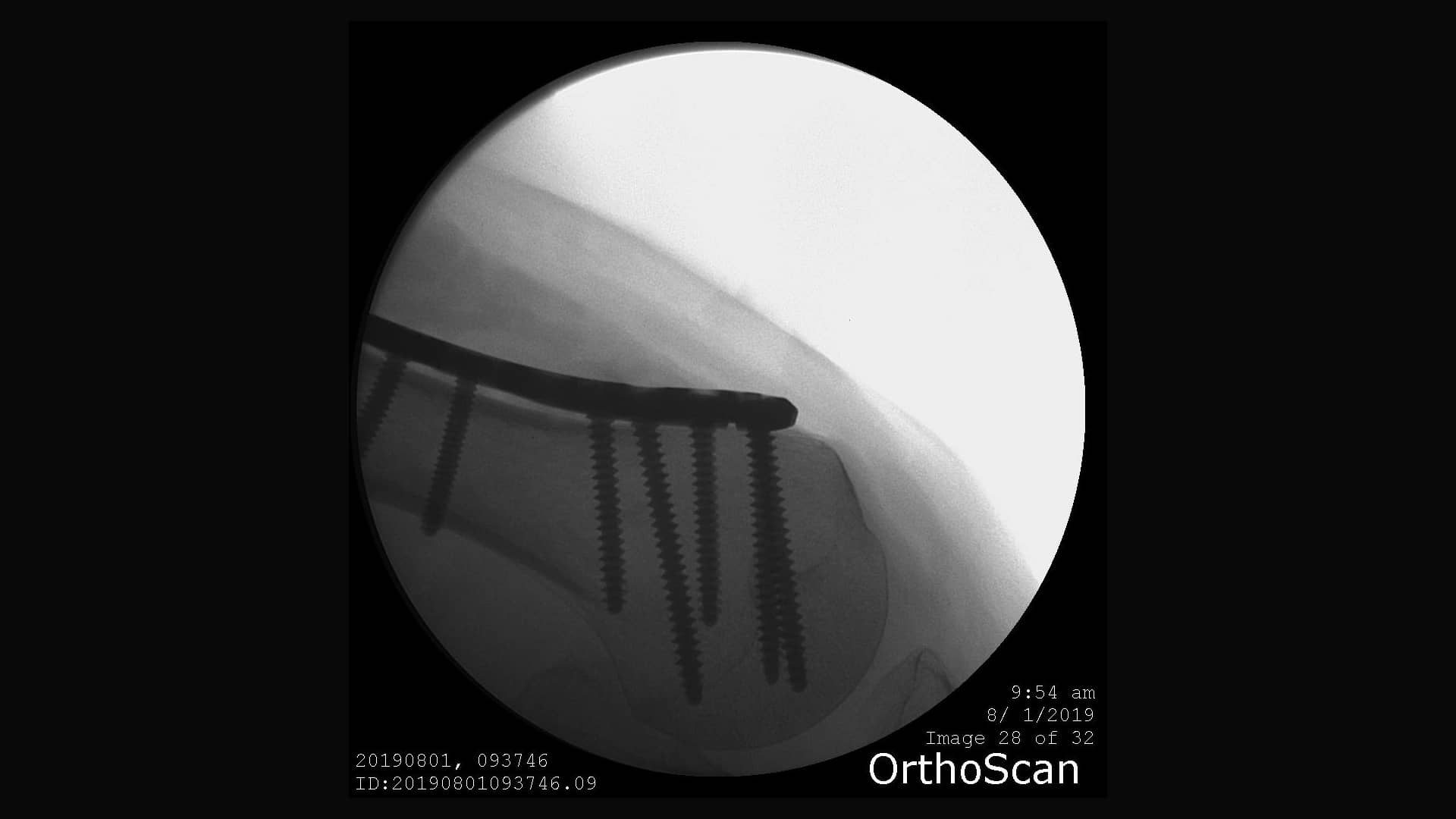 Humeral Plating with Kenneth Koval, MD on Vimeo