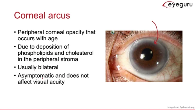 Corneal Arcus