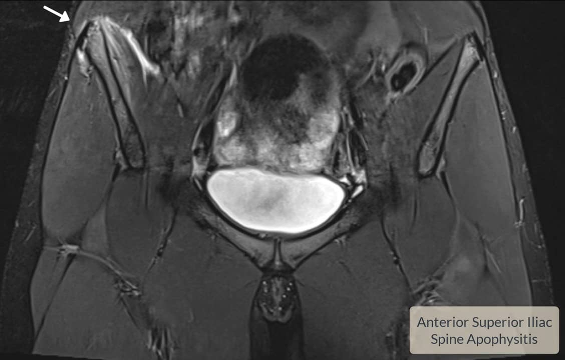 Anterior Superior Iliac Spine Apophysitis on Vimeo