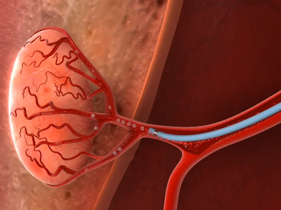 Embosphere® Microspheres