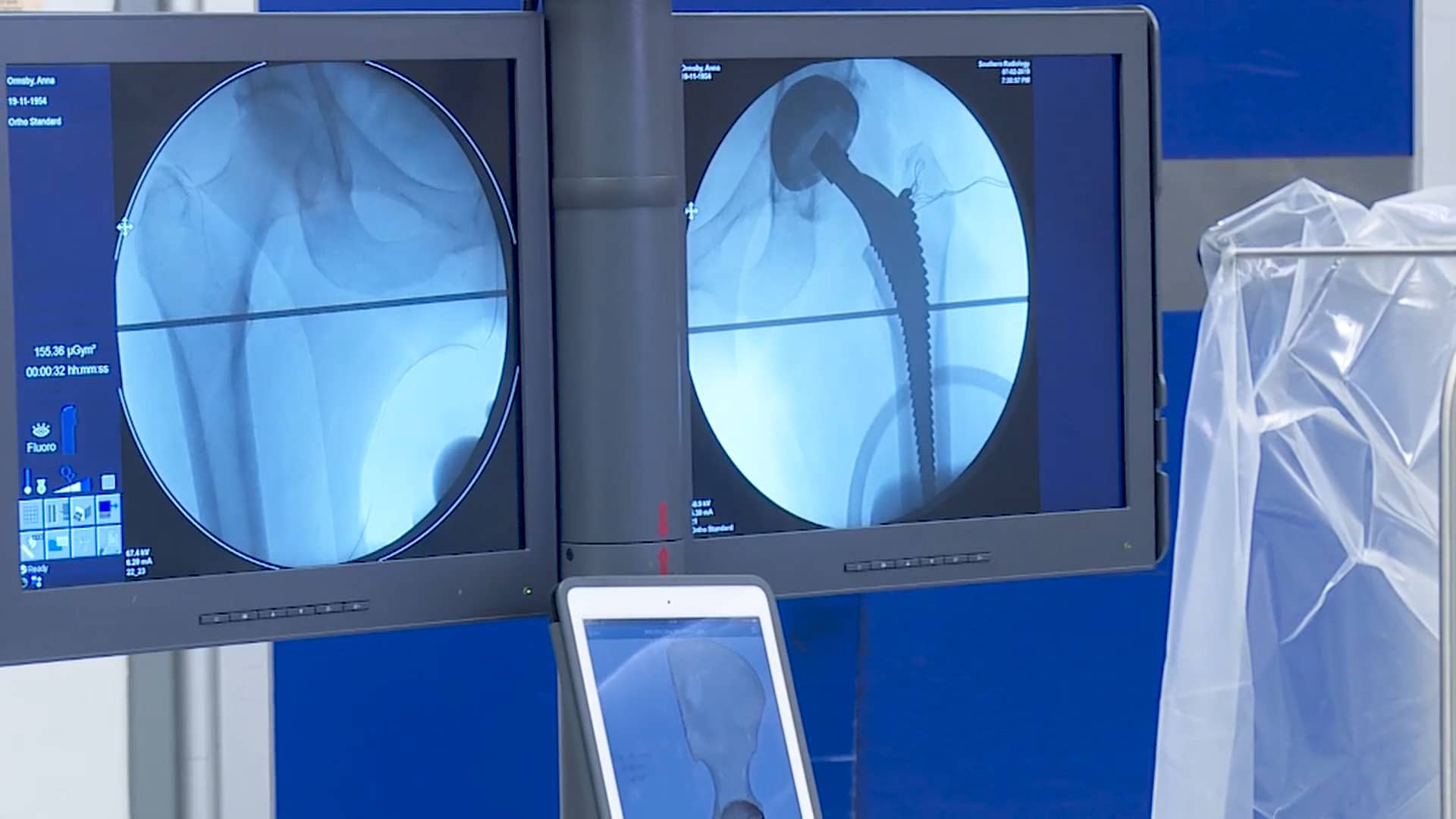 Direct Anterior Total Hip Arthroplasty using Corin Optimized ...