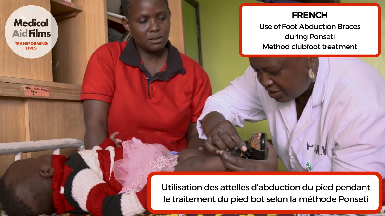 Utilisation des attelles d’abduction du pied pendant le traitement du ...