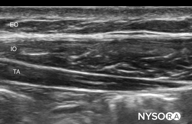 Ultrasound-Guided Transversus Abdominis Plane And Quadratus, 52% OFF