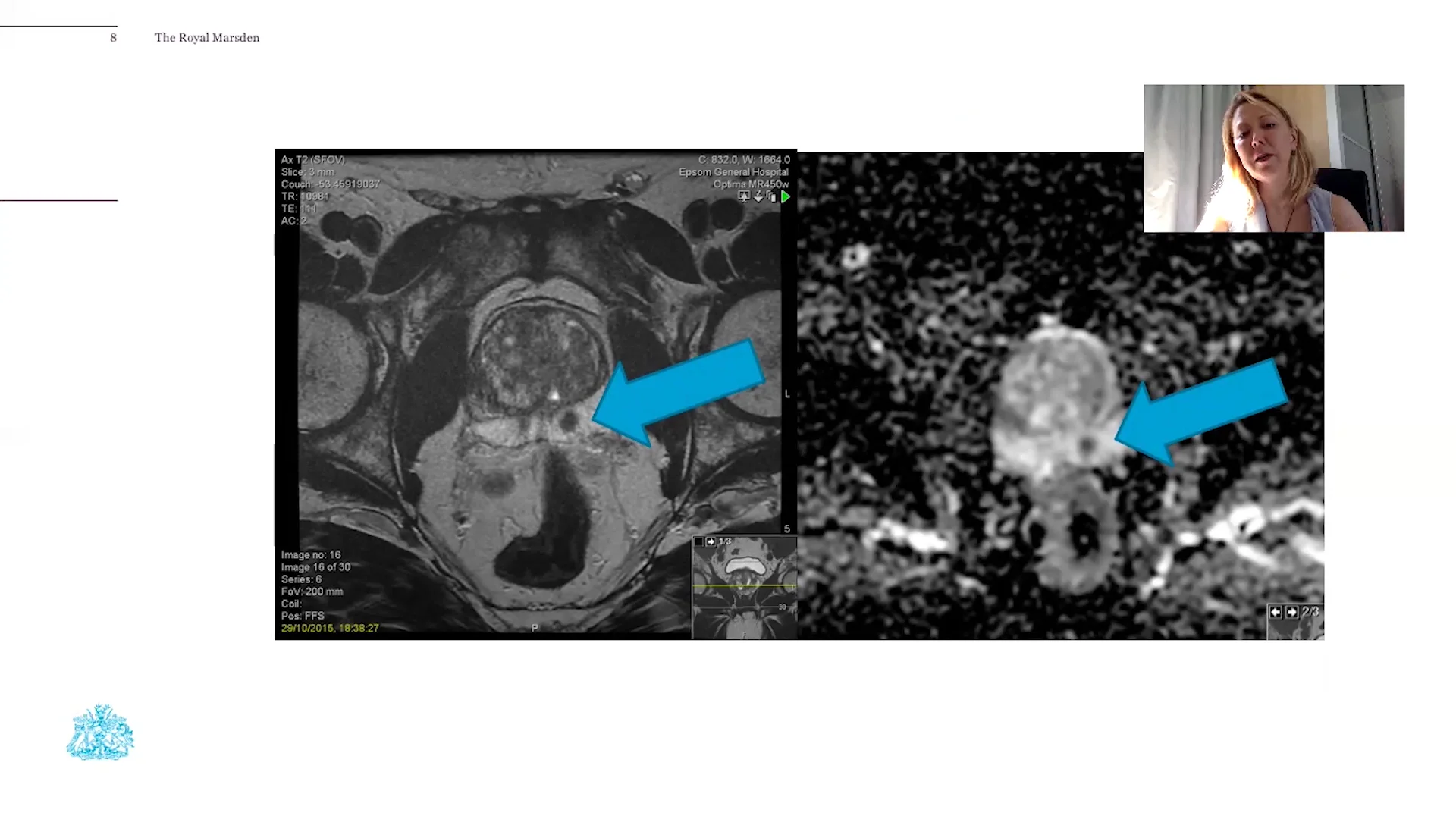 Dr Alison Tree - Prostate Cancer Treatment on Vimeo