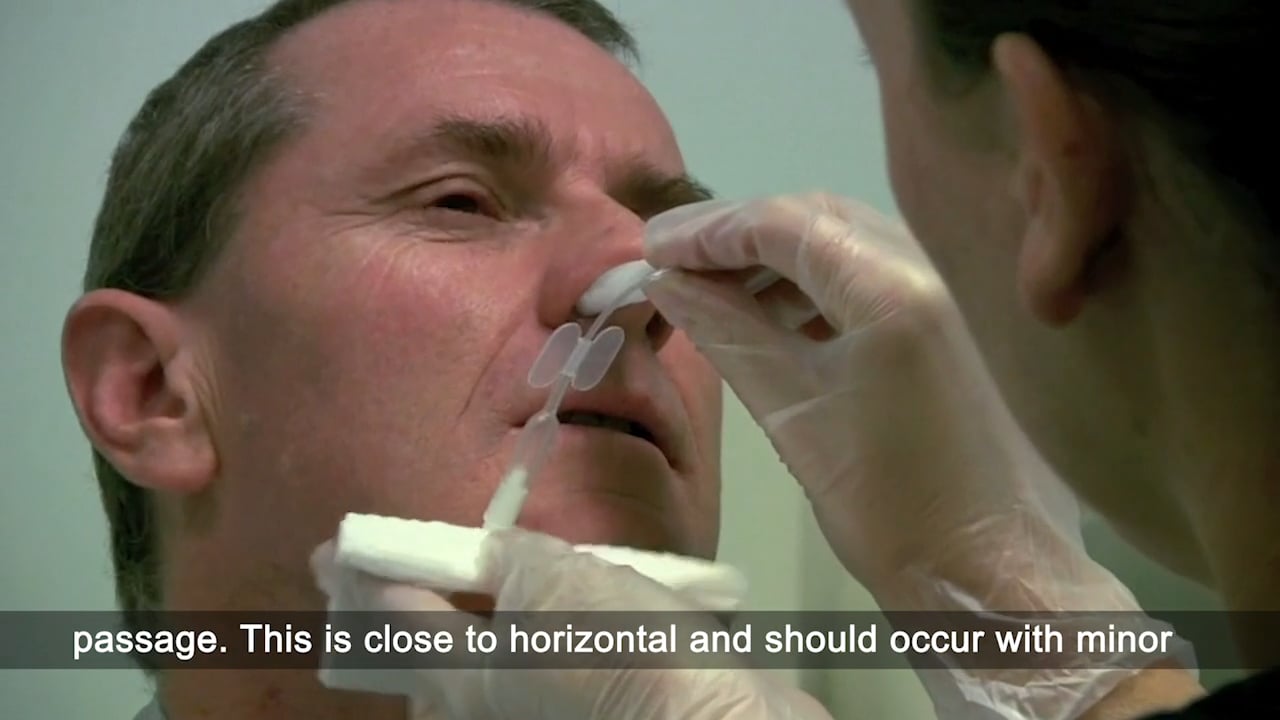 Epistaxis Rapid Rhino INsertion on Vimeo