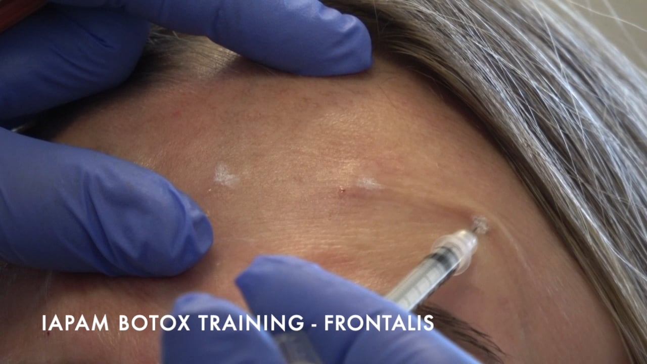 Botox Training - Injecting Frontalis on Vimeo
