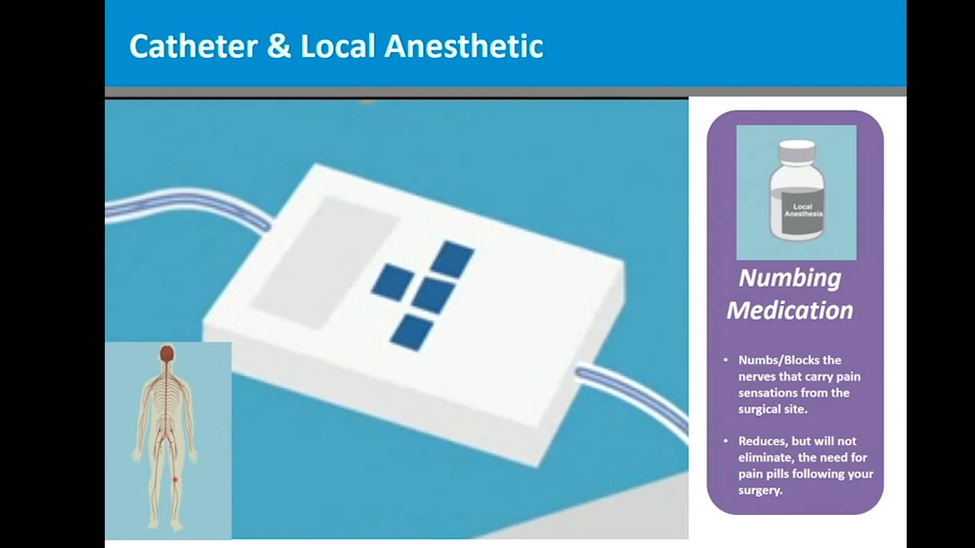 Knee InfuBLOCK on Vimeo